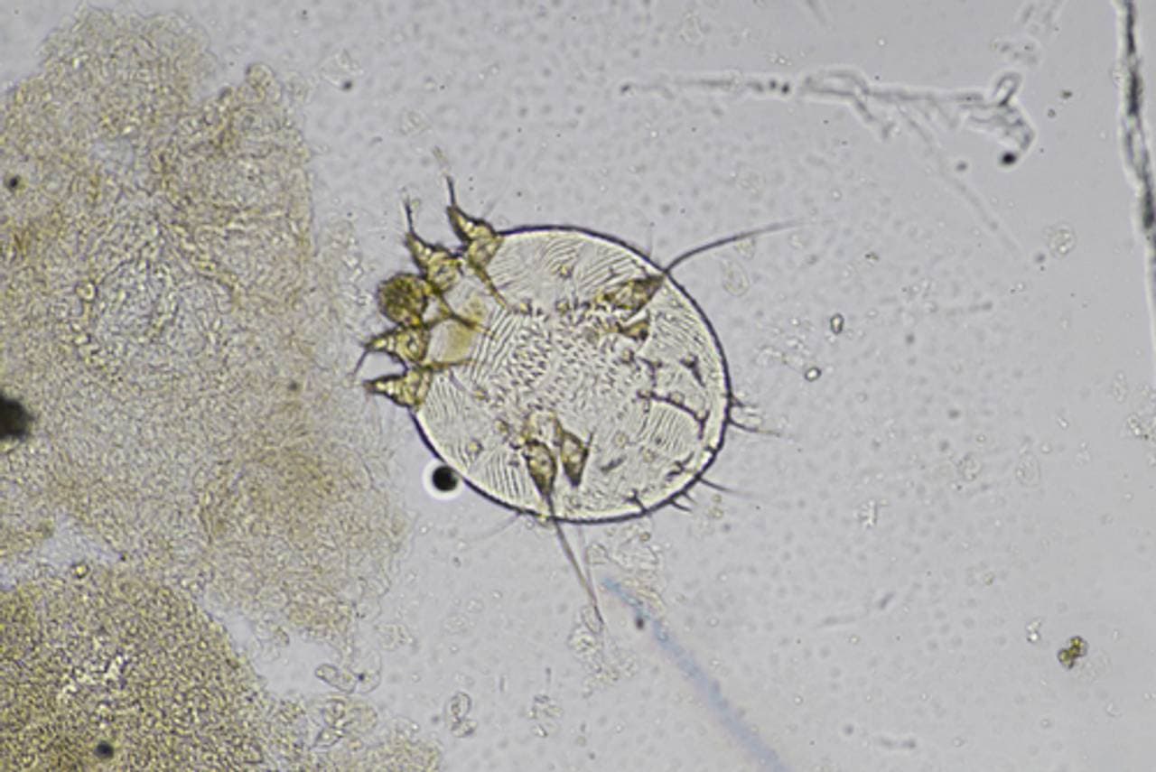 Scabia (raia): contagiozitate, tratament si igiena | Bioclinica
